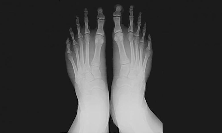 Foot-O-Scope: Floroskopi İle Doğru Ayakkabıyı Seçme Çılgınlığı