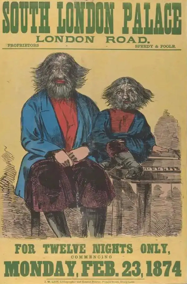 Güzel ve Çirkin Masalına İlham Veren Hipertrikoz (Kurt Adam Hastalığı ...